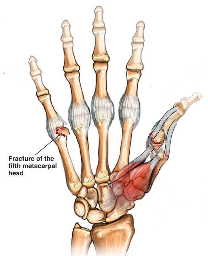 All About Boxer’s Fracture – Tynor Australia